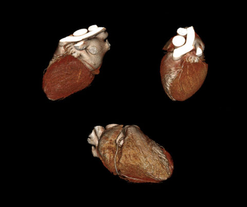 3D CT Angiography: Who Needs This Advanced Heart Scan?
