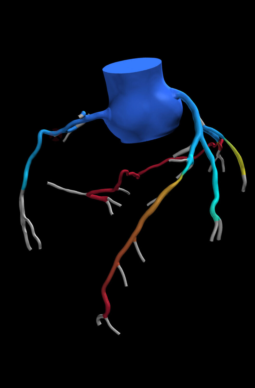 HeartFlow CT-FFR - Rochester Medical Center