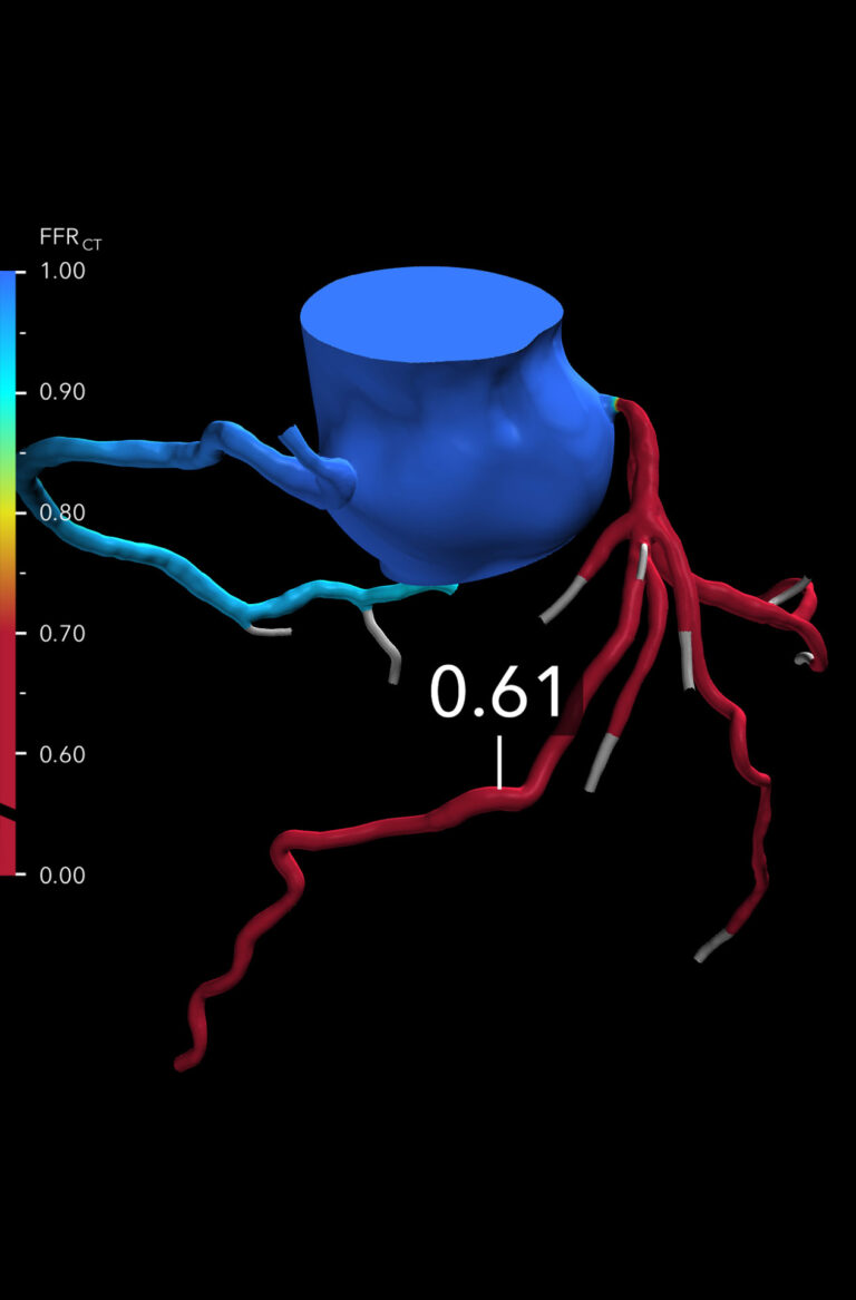 HeartFlow CT-FFR - Rochester Medical Center