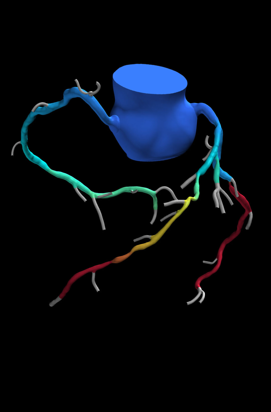 HeartFlow CT-FFR - Rochester Medical Center